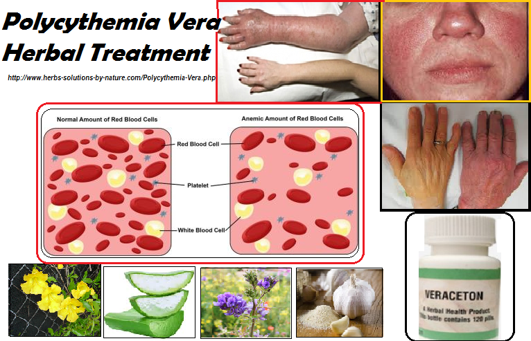 Polycythemia Vera Herbal Treatment - Herbs Solutions by Nature