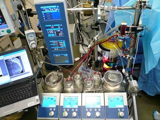 Le principe de la circulation extra corporelle - Au coeur de Nab