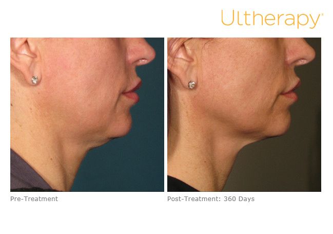 l’Ultherapy ® : le Lift sans chirurgie - Martine et le slow aging