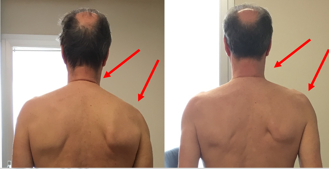 Traitements posturaux et hyperkyphose : 8 séances INDIBA activ en ...