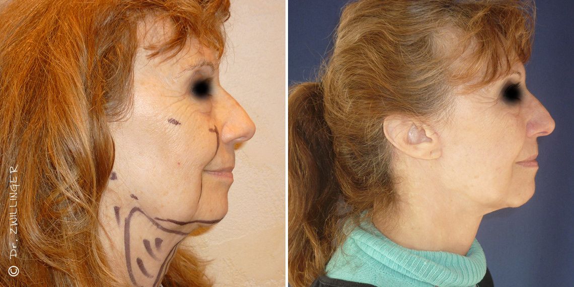 Le lifting temporal va vous permettre de retrouver le regard de votre ...