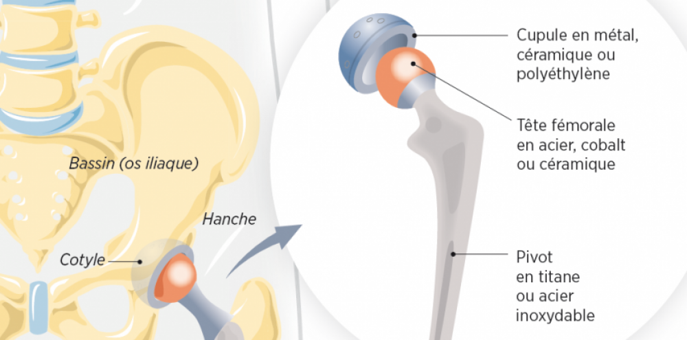 Prothèse totale de hanche - Tige fémorale (Orthopédie) - Tige Exel R ...