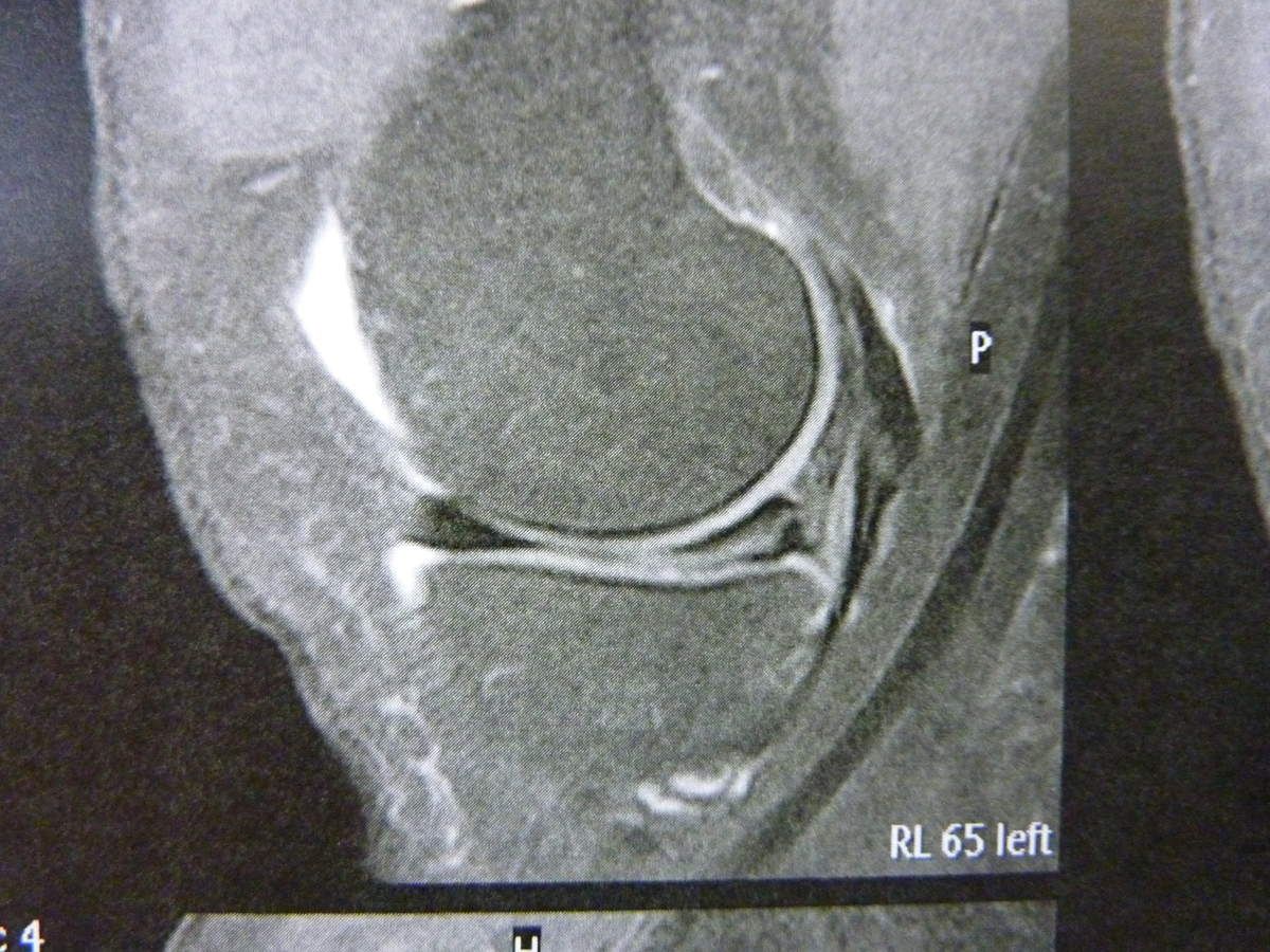 - LES LESIONS MENISCALES - site du Docteur Jean Pierre LANTUEJOUL