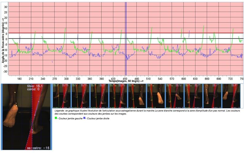 Thomas RAVON donne son avis sur les semelles orthopédiques KINEPOD ...
