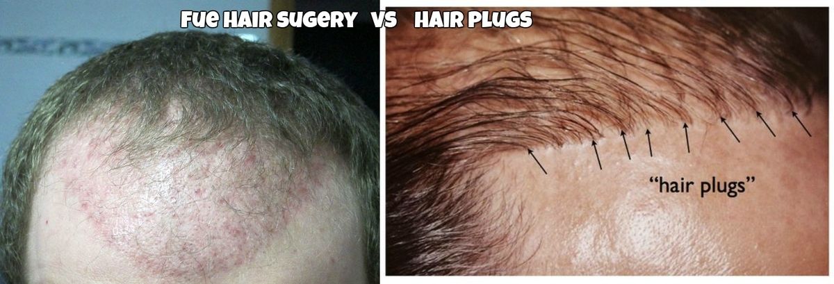 The Clear Distinction between Hair Plugs and Hair Transplant Surgery ...