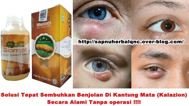 Cara Menyembuhkan Benjolan Di Kantung Mata (Kalazion) Secara Alami ...