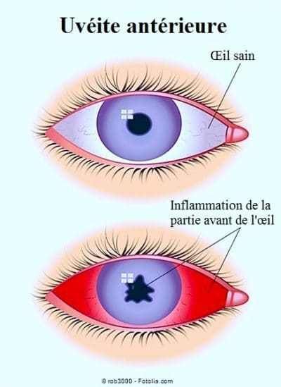 Uvéite - les spondylarthropathies, maladie auto-immune