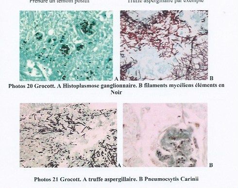 Chapitre XII (suite 6) coloration Grimelius, Grocott - anatomopathologie