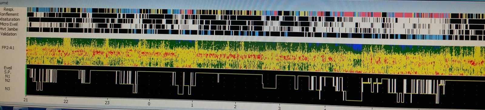 Comprendre l'Apnée du Sommeil - Comment Gérer son Sommeil