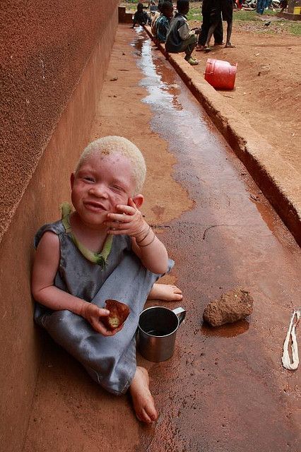 Les Enfants Albinos - AFRIQUE : LES ENFANTS OUBLIES