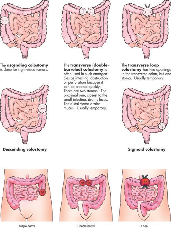 Transverse Colostomy